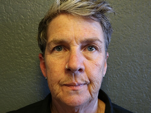 Facelift | Before & After Photo Gallery | Phoenix, AZ | Jennifer Boll, MD