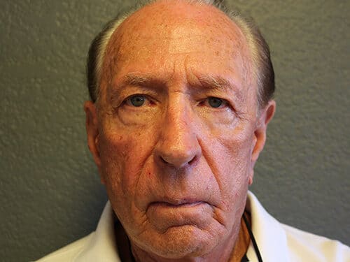 Facelift Archives - Jennifer Boll, MD