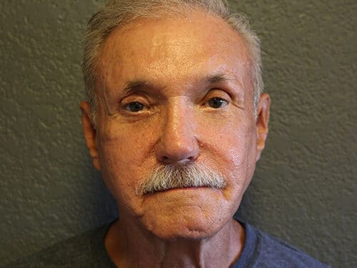 Facelift Archives - Jennifer Boll, MD