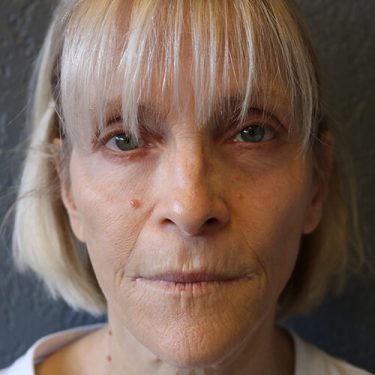 Facelift Archives - Jennifer Boll, MD