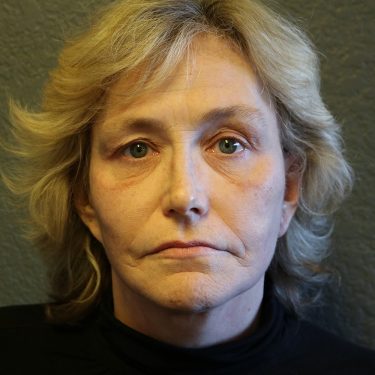 Facelift Archives - Jennifer Boll, MD