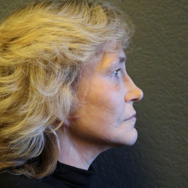 Facelift Archives - Jennifer Boll, MD