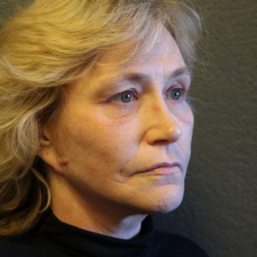 Facelift Archives - Jennifer Boll, MD