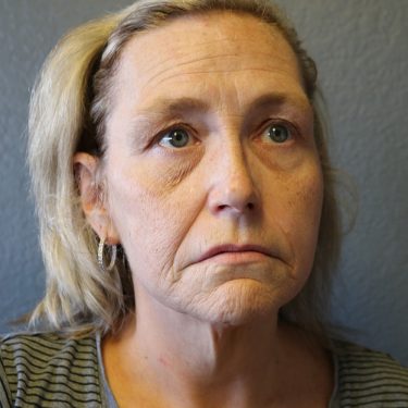 Facelift Archives - Jennifer Boll, MD